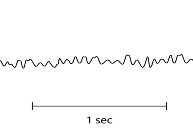 Electroencephalogram (EEG) - Alfredo H. Arellano PMHCNS,BC