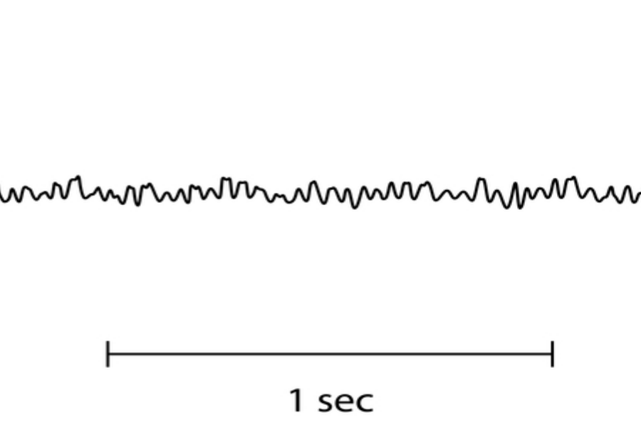 Electroencephalogram (EEG) - Alfredo H. Arellano PMHCNS,BC