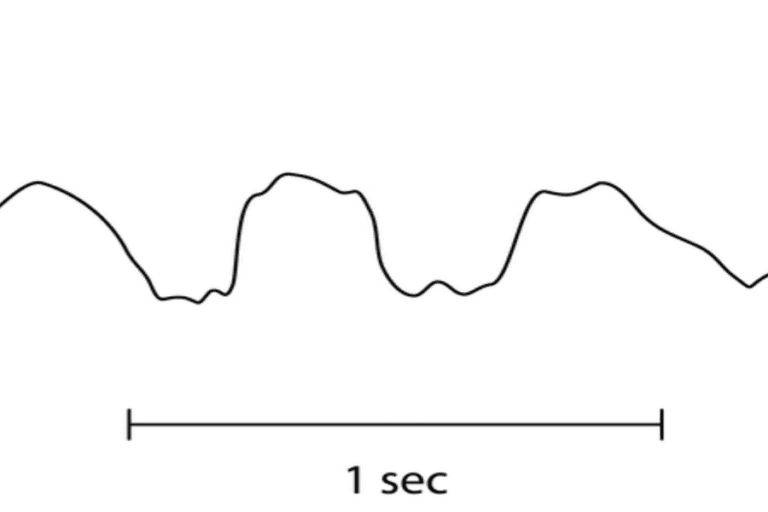 Electroencephalogram (EEG) - Alfredo H. Arellano PMHCNS,BC