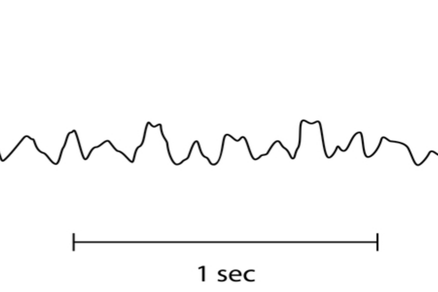 Electroencephalogram (EEG) - Alfredo H. Arellano PMHCNS,BC