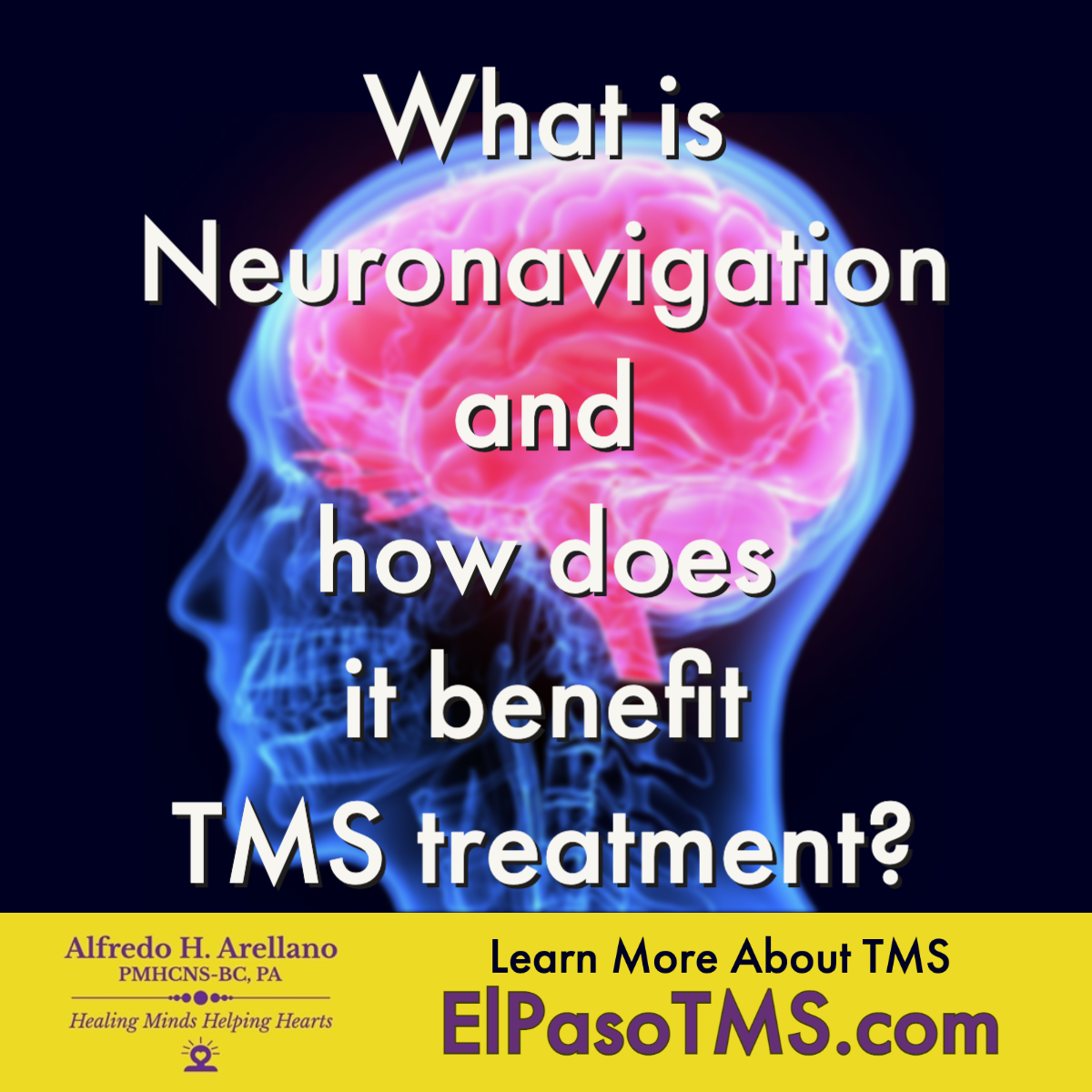 What is Neuronavigation and how does it benefit TMS treatment ...